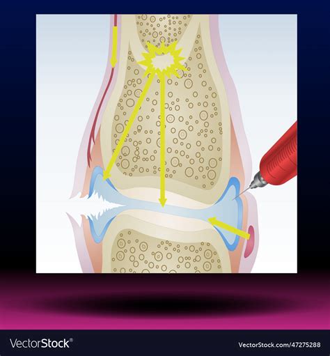 Rheumatoid Arthritis Royalty Free Vector Image
