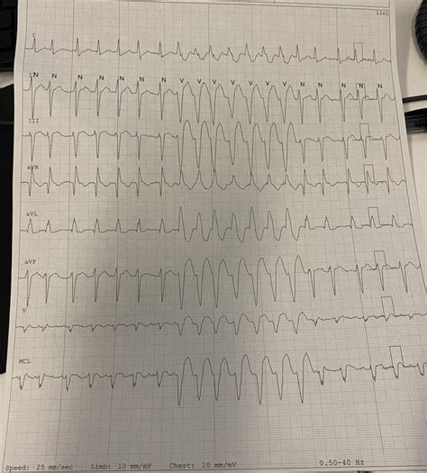 Shortened Pr Interval R Cardiology