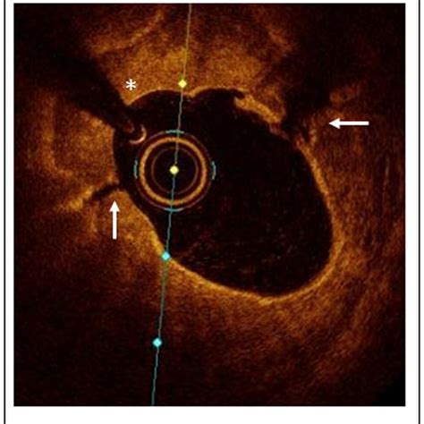 Classification Of Calcification Oct Cross Section Demonstrating Download Scientific Diagram
