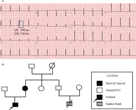 Pedigree Of The Short QT Syndrome Family A ECG Of The Proband B