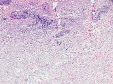 Xanthogranulomatous Dermatopathology