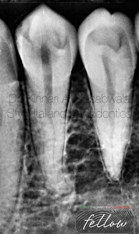Management Of Mandibular First Premolars With Unique Anatomies Style Italiano Endodontics