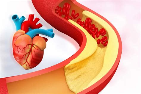 Manage High Blood Cholesterol Levels Heart Foundation