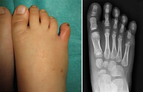 Types Of Toe Dislocation At Christopher Bryant Blog