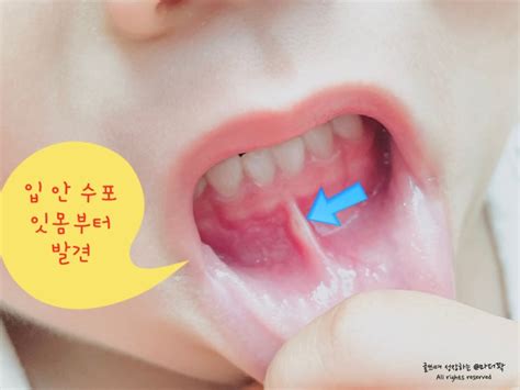 아기 구내염 수족구 차이 입안 유아 수포 어린이 구내염 증상 순서 네이버 블로그