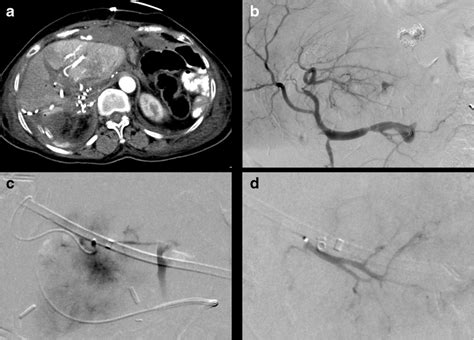 Case Of A 66 Year Old Patient Who Underwent Right Hemihepatectomy To Download Scientific