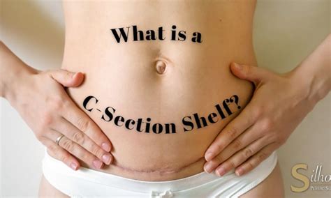 C Section Incision Before And After