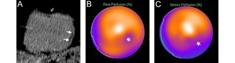 Examples Of Post Infarction Imfs From Cacs ≥ 300 Group A Cac Ct Download Scientific Diagram