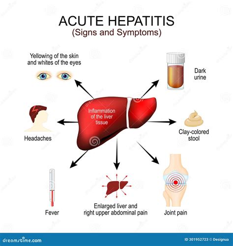 Hepatitis Symptoms Stock Vector Illustration Of Damage 301952723