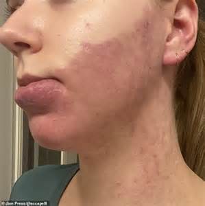 Woman 28 Who Was Born With A Large Port Wine Stain Birthmark Across