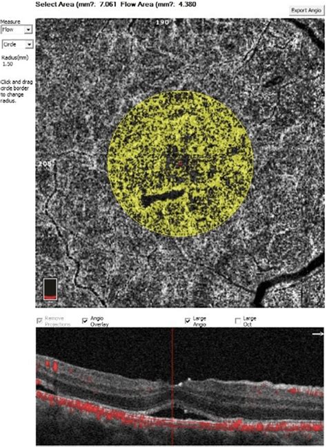Measurement Of Choriocapillaris Flow Density Using The Optovue Hd Angio