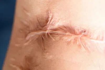The Types Of Scars And Their Characteristics