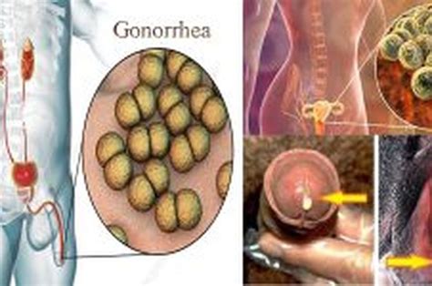 Sering Terjadi Pada Pria Waspada Gejala Penyebab Dan Cara Mencegah Penyakit Infeksi Gonore