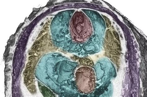 Incredible Worm Fossil Solves Mystery Of How Insects And Spiders