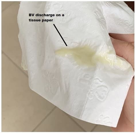 Bacterial Vaginosis Bv Discharge Pics Infection Vaginitis Std