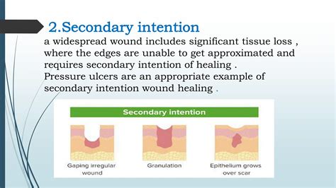 Wound Healing Pdf