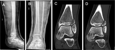 Tillaux Fracture In Adults Case Report And Review Of Literature
