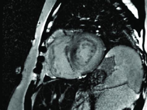 Short Axis View Of The Cardiac MRI Showing Diffuse Subendocardial Download Scientific