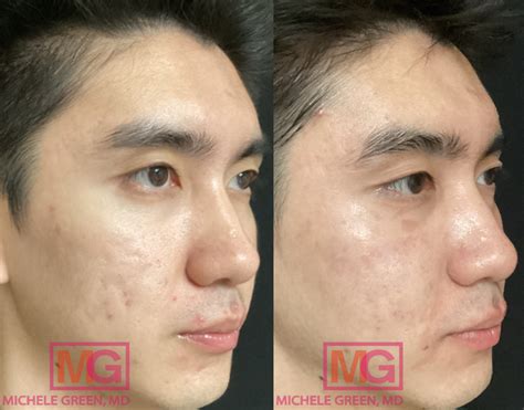 Atrophic Scarring Treatment For Atrophic Scars Dr Michele Green M D