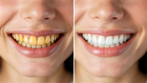 Castro Valley Ca Prevent Teeth Staining By Hiring A Mobile Dental