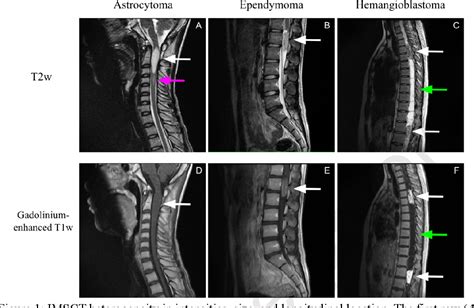 Figure 1 From Automatic Multiclass Intramedullary Spinal Cord Tumor