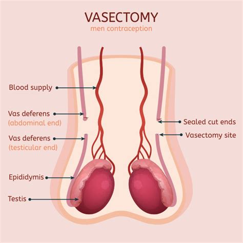 Vasectomy Reversal Raleigh Nc