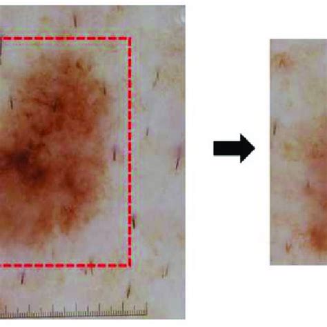 Pdf Deep Learning Classifier With Patients Metadata Of Dermoscopic