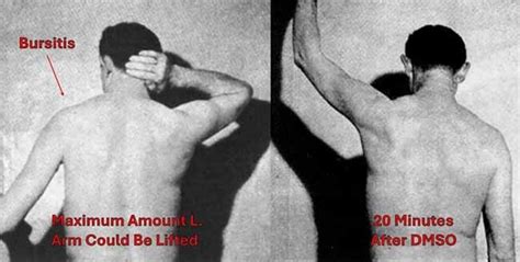 DMSO Is A Miraculous Therapy For Pain And Tissue Injury