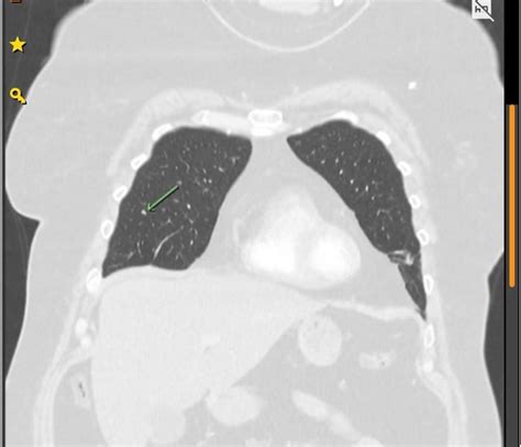 Thoracic Ct Scan With Contrast R Medical