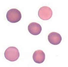 Celulas Sanguineas Atlas de hematología Anormalidades serie eritroide