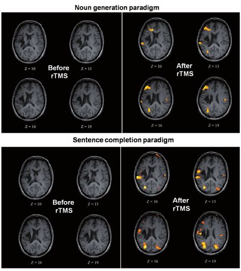 Statistical Parametric Mapping Spm T Results Of Noun Generation And Download Scientific