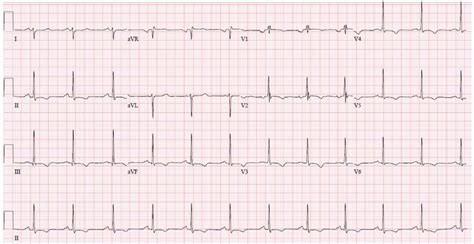 What Causes A Right Axis Deviation At Sam Mcclendon Blog
