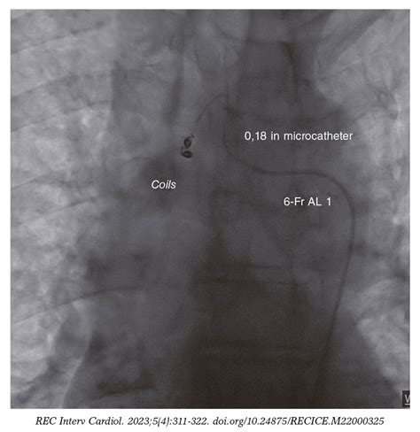 Massive Hemoptysis Selective Embolization Of Bronchial Artery Left