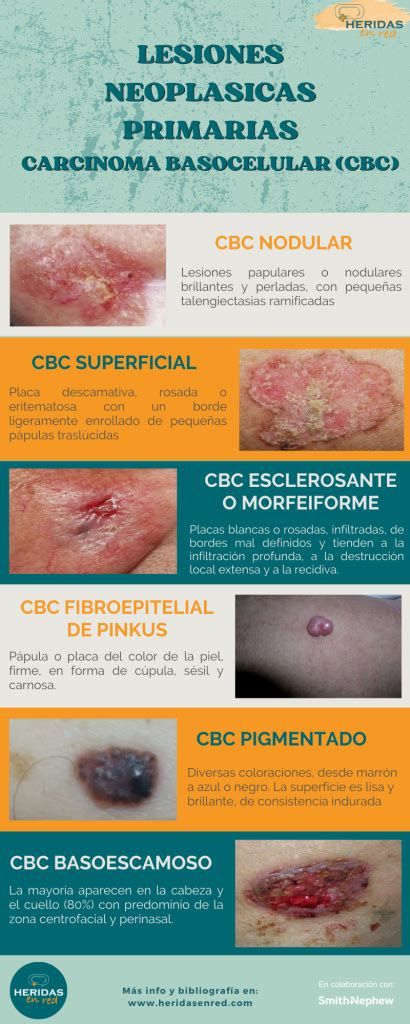 Carcinoma Basocelular Ulcerativo Basal Cell Carcinoma Ulcerated