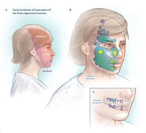 Trigeminal Neuralgia Trigger Points