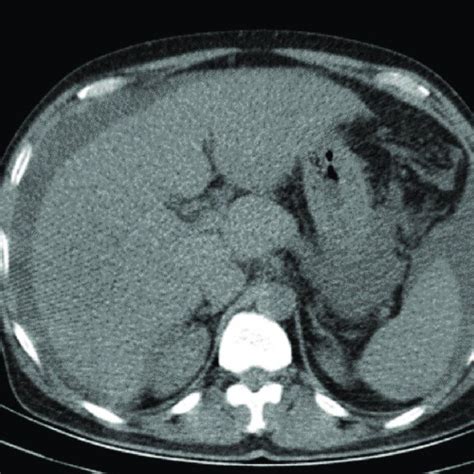 B Unenhanced Axial Ct Scan Shows Slightly Heterogeneous Liver