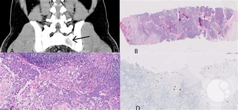 Secondary Myelofibrosis As Paraneoplastic Phenomenon In Patient With