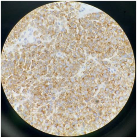Synaptophysin Stain 600× Magnification Of Gastric Mucosal Biopsy
