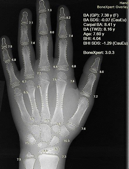 Bone Age Wikiwand