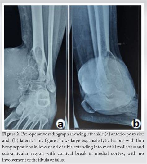A Case Report Of Giant Aneurysmal Bone Cyst Of Distal Tibia With A Non