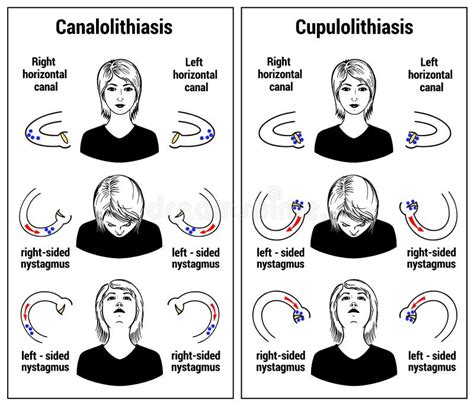 Cupulolithiasis Stock Illustrations 6 Cupulolithiasis Stock