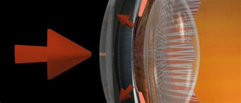 Corneal Molding Or Ortho K