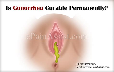 Is Gonorrhea Curable Permanently