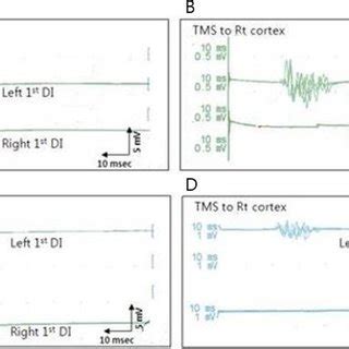 TMS At The Ages Of A B And C D The Right And Left St Download Scientific Diagram