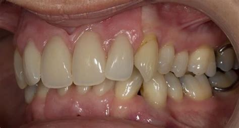 Rotational Path Of Insertion Rpds With Fantastic Aesthetics Full