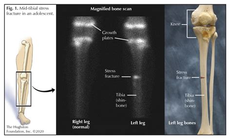 Stress Fractures In Adolescent Athletes Hughston Clinic