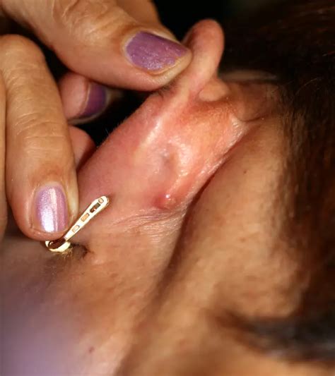 Infected Ear Piercing Expert Guide To Symptoms And Prevention