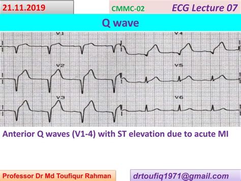 Ecg Q Wave Ppt