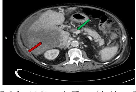 Figure 1 From Intrahepatic Cholangiocarcinoma In A Patient With Alcoholic Liver Cirrhosis And