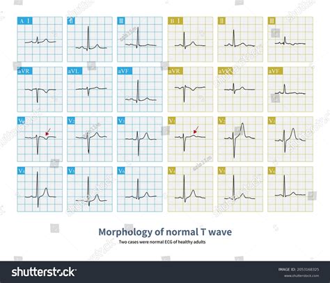 Under Normal Conditions T Wave V1 Stock Illustration 2053168325